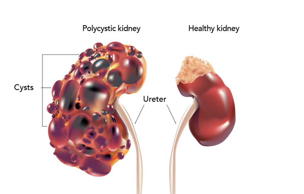 Clearing the Air for Healthy Kidneys: Unveiling the Power of D-orbital ...